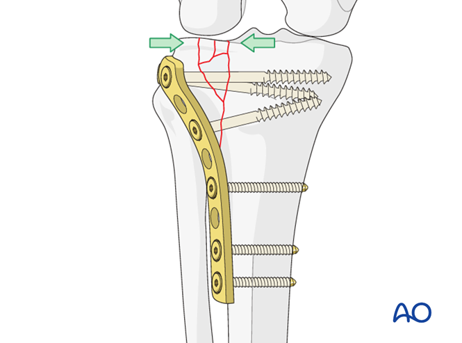 ORIF - Plates without angular stability for Partial articular fracture ...