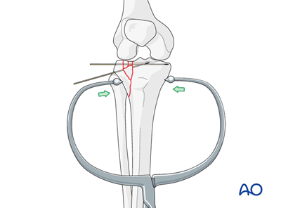 ORIF - Plates without angular stability for Partial articular fracture ...