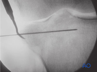 ORIF - Plates without angular stability for Partial articular fracture ...