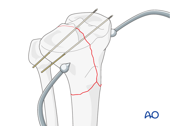 ORIF - Plates without angular stability for Complete articular fracture ...