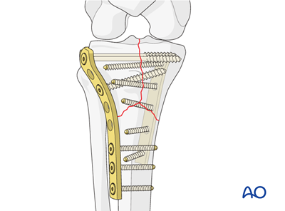 ORIF - Plates without angular stability for Complete articular fracture ...