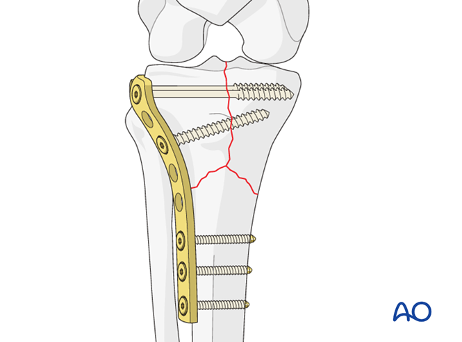 ORIF - Plates without angular stability for Complete articular fracture ...