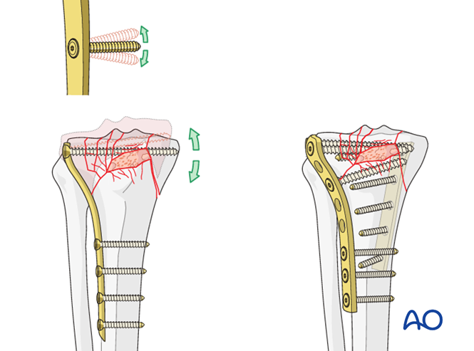 ORIF - Conventional plates for Complete articular fracture, fragmentary ...