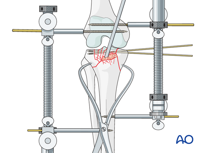 ORIF - Conventional plates for Complete articular fracture, fragmentary ...
