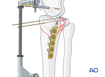 ORIF - Conventional plates for Complete articular fracture, fragmentary ...