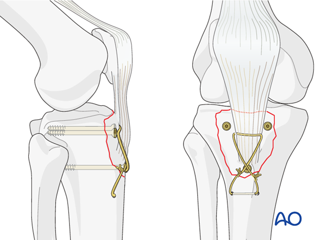 Lag screws for Extraarticular fracture, avulsion of tibial tubercle
