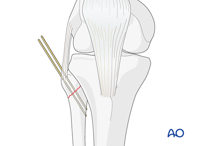 Tension band fixation for Extraarticular fracture, avulsion of fibular head