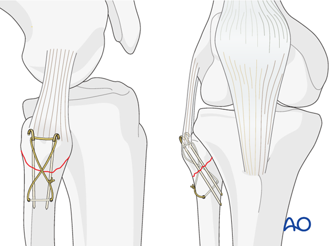 Tension band fixation for Extraarticular fracture, avulsion of fibular head