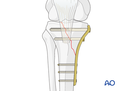 ORIF - Plates without angular stability for Partial articular fracture ...