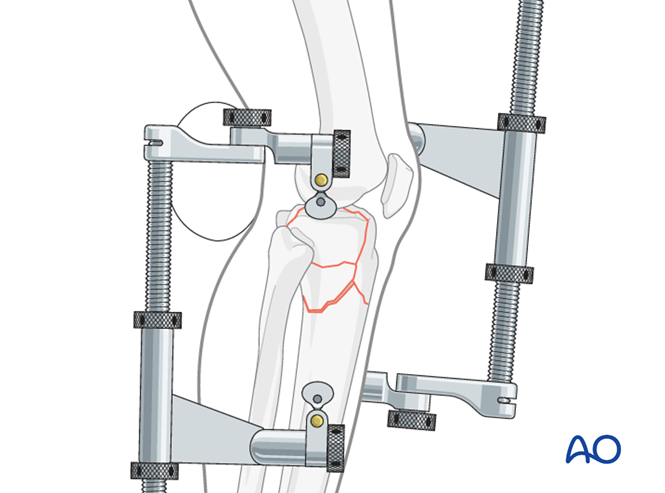 ORIF - Conventional plates for Complete articular fracture, simple ...