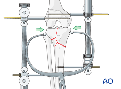 Ring external fixator (definitive) for Complete articular fracture ...