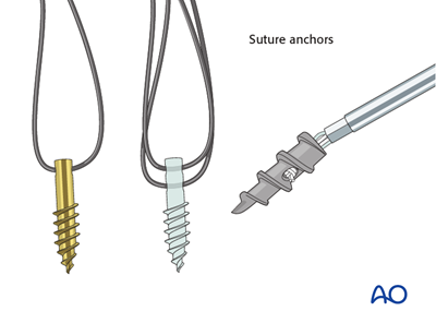 Suture anchors for Extraarticular fracture, avulsion of tibial tubercle