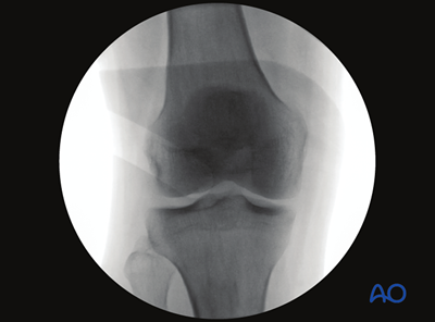 Intraoperative imaging of the proximal tibia