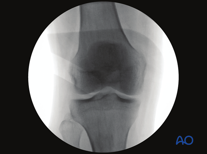 Intraoperative imaging of the proximal tibia