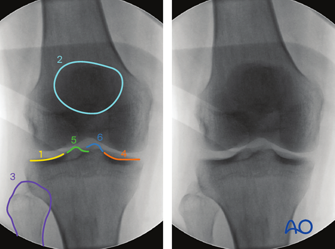 Intraoperative imaging of the proximal tibia