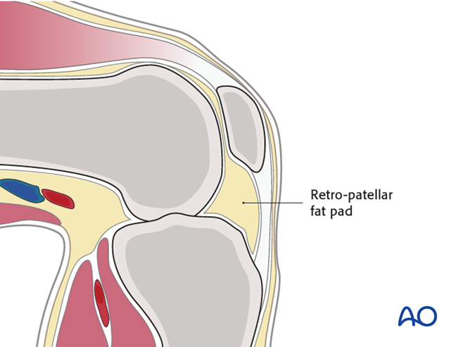 Nailing limited open approach to the distal tibia