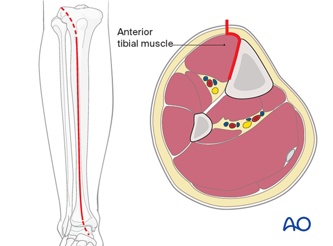 Approach to the anterolateral surface of the tibial shaft