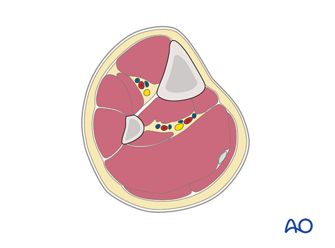 Approach to the posterolateral surface of the tibial shaft