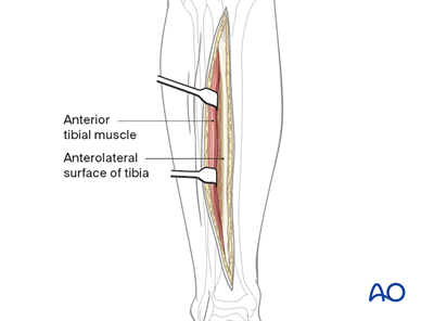 Approach to the anterolateral surface of the tibial shaft