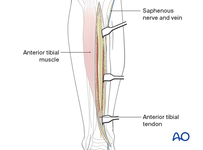 Approach to the anteromedial surface of the tibial shaft