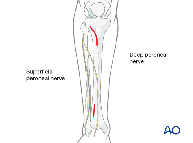 Minimally invasive lateral approach to the tibial shaft