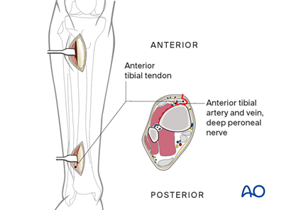 Minimally invasive lateral approach to the tibial shaft
