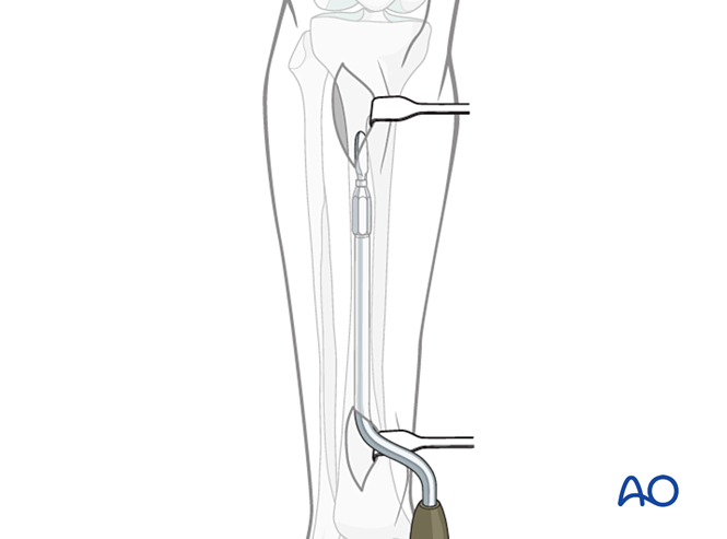 Minimally invasive lateral approach to the tibial shaft