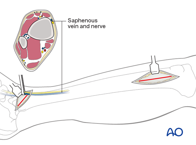 Minimally invasive medial approach to the tibial shaft