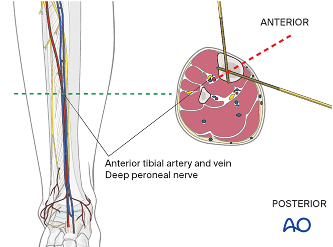 Safe zones in the tibia for pin insertion