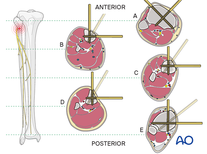 Safe zones in the tibia for wire and Schanz screw insertion