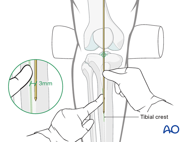 Semi-extended lateral parapatellar approach for intramedullary nailing ...