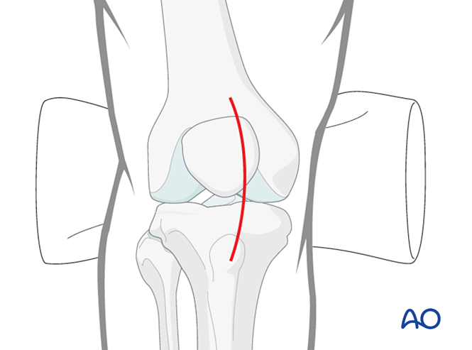 Intramedullary nailing for Wedge fracture, fragmented wedge