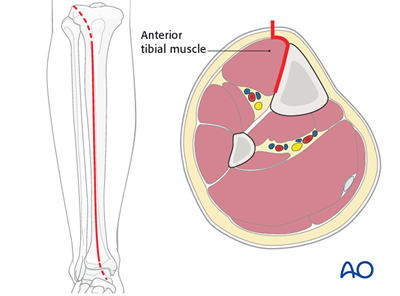 Approach to the anterolateral surface of the tibia