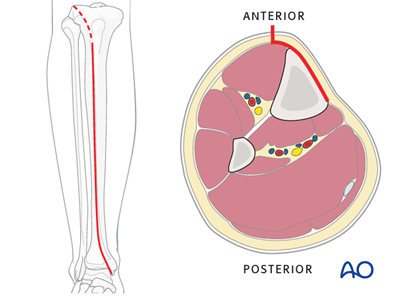Approach to the anteromedial surface of the tibia