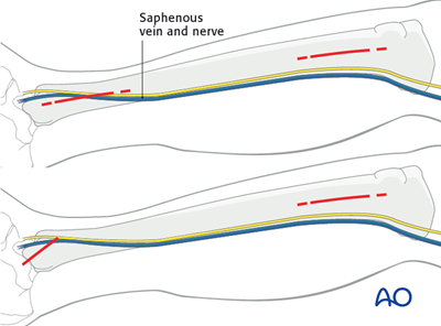 Minimally invasive medial approach to the tibial shaft