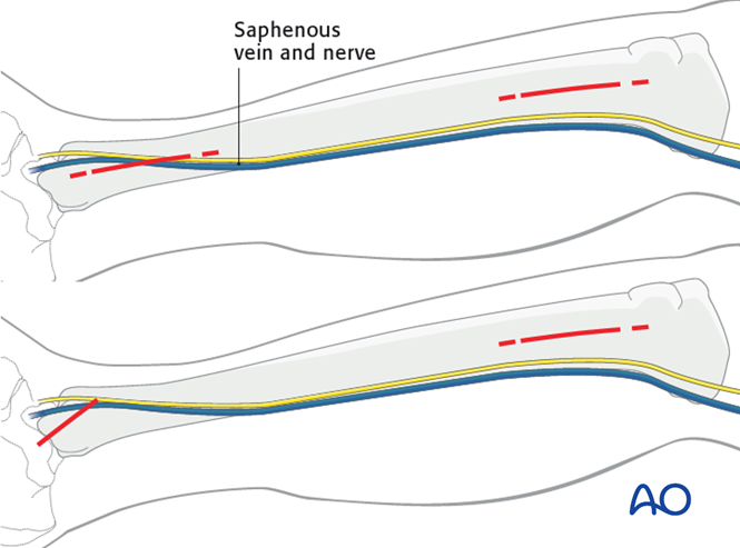 Minimally invasive medial approach to the tibial shaft
