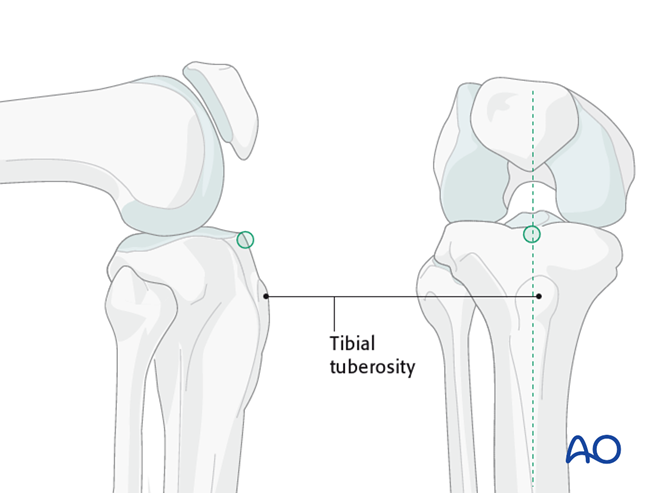Tibial Entry Point: Tibial Nail Surgery Technique – BLVB