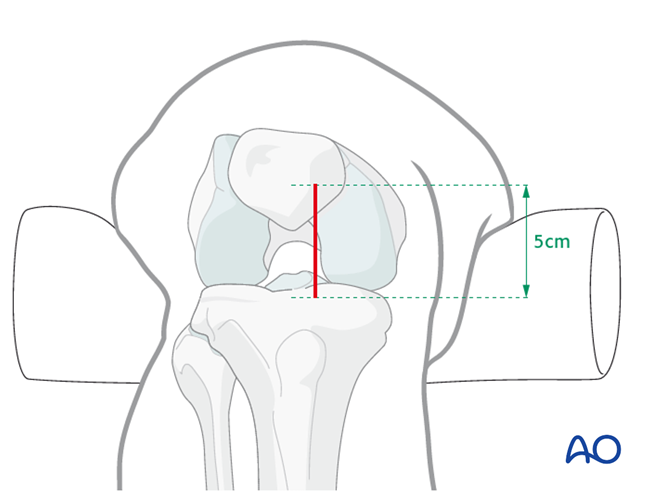Approach for intramedullary nailing of the tibial shaft