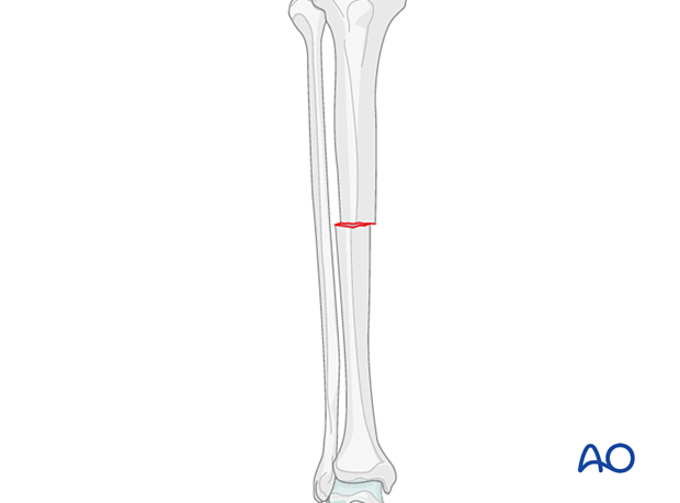 Simple transverse fracture