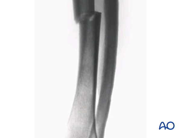 Simple transverse fracture