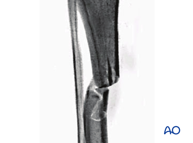 Wedge fracture with a fragmented wedge