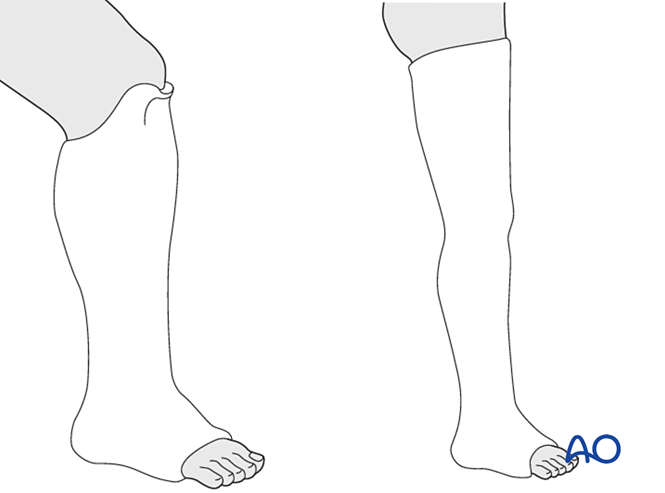 Nonoperative treatment (casting) for Wedge fracture, fragmented wedge