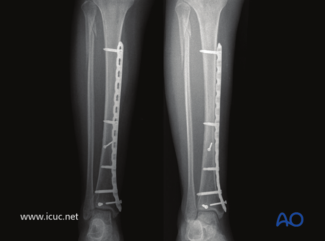 ORIF - Lag screws outside protection plate for Simple fracture, spiral