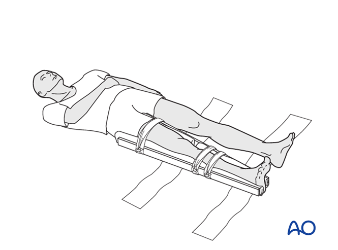 Fracture management with limited resources