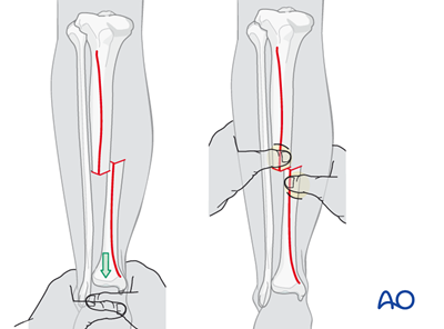 Fracture management with limited resources