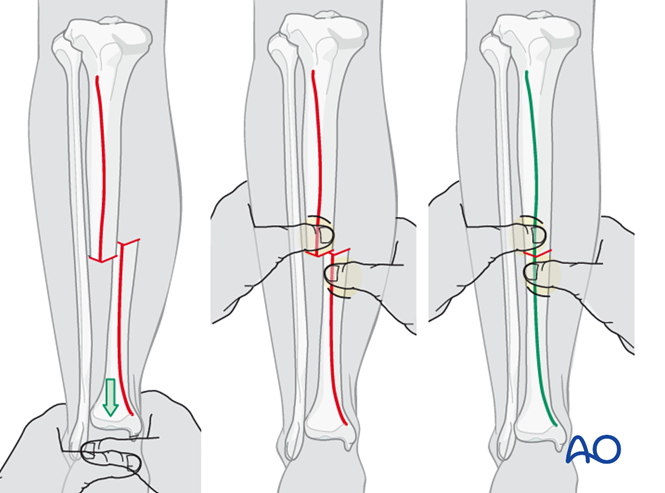 Fracture management with limited resources