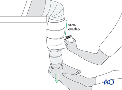 Fracture management with limited resources