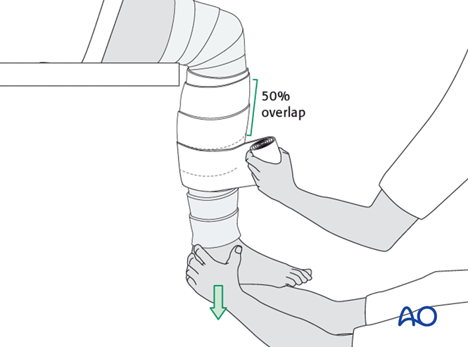 Fracture management with limited resources