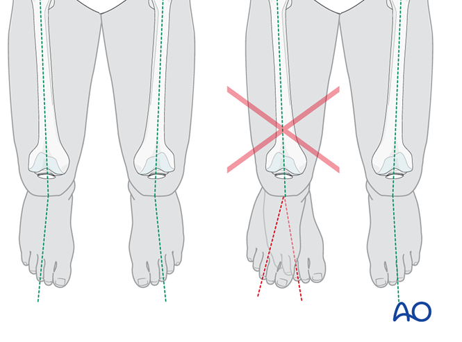 Fracture management with limited resources