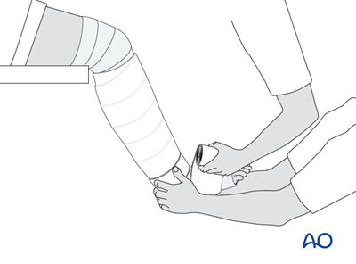 Fracture management with limited resources